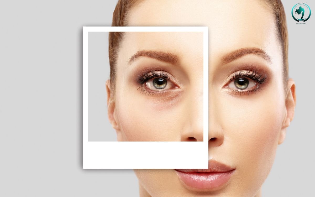 Những điều cần lưu ý khi thực hiện phẫu thuật cắt mí mắt? - snose.vn